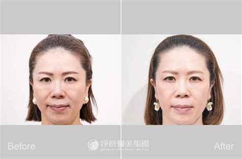 娜柏塔nabota彩虹肉毒 介紹、效果、副作用 微整注射