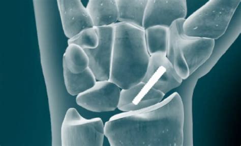 Scaphoid Fracture Physical Therapy Protocol At Kathy Lighty Blog