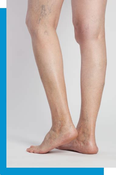 Phlebectomy Bellamah Vein Clinic