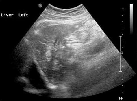 Ultrasound Scan Of The Abdomen Demonstrating Multiple Echogenic Foci Download Scientific