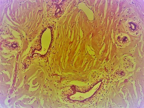 Sayed Attar On Linkedin Left Breast Ill Defined Mass 3 5x2 5 Cm Grayish White Glistening…