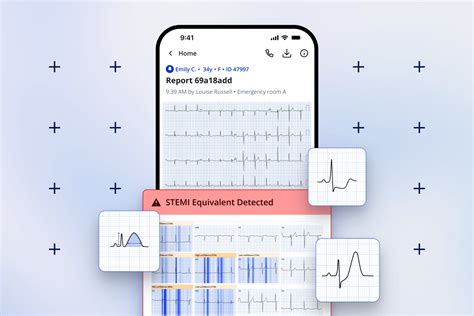 Stemi Ecg Criteria Key Insights Into Ischemic St Elevation Patterns