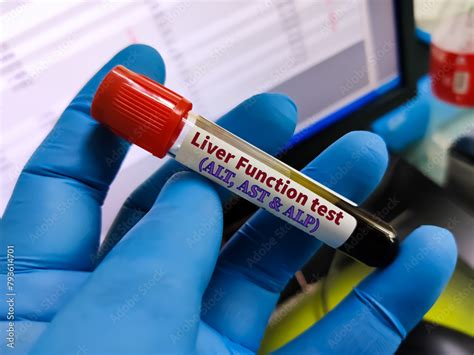Blood Sample For Liver Function Test ALT AST And ALP To Diagnosis Liver Disease Stock Photo