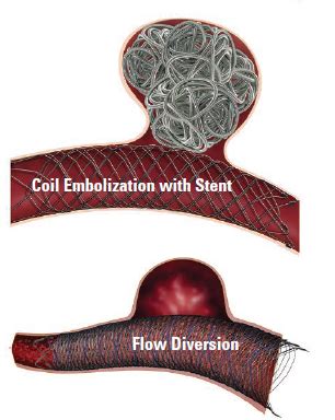 What Is A Brain Aneurysm Why Do 1 In 50 People Have Them