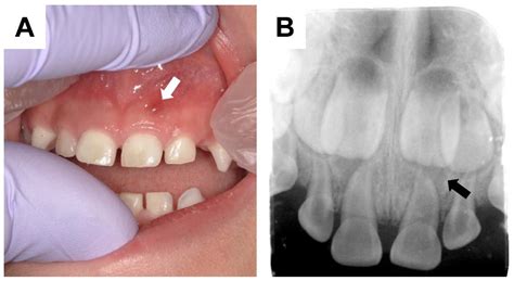 Dental Manifestations And Oral Management Of X Linked Hypophosphatemia