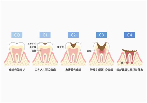 歯科検診の「c」「c1」ってどういう意味？ 豊田デンタルクリニック｜豊田駅徒歩4分｜イオンモール多摩平の森近くの優しい歯医者さん