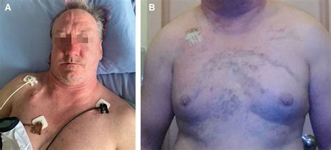 Superior Vena Cava Syndrome Causes Symptoms Diagnosis Treatment