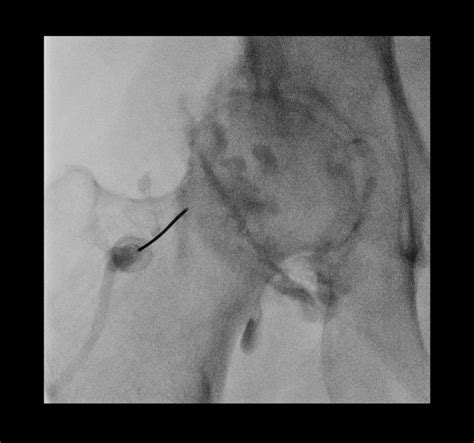 Hip Injection Disambiguation Radiology Reference Article Radiopaedia Org