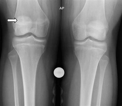 Dorsal Defect Of The Patella In A Teenage Male Football Player A Case