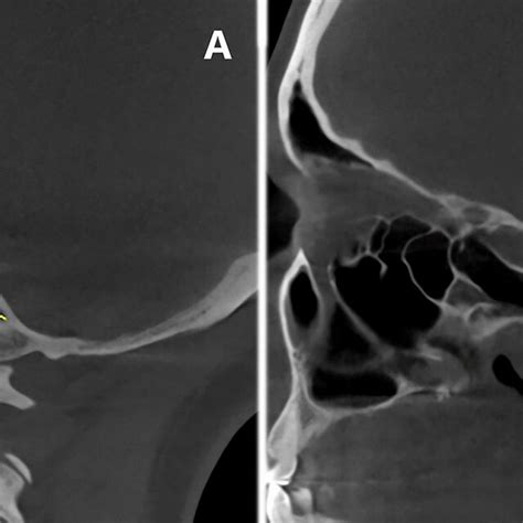 A Hypoglossal Canal Widest Diameter B Hypoglossal Canal Narrowest