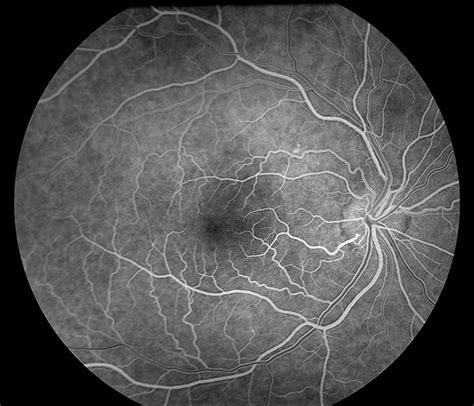 How To Interpret Fluorescein Angiography 6 Types Of Defects Eyeguru