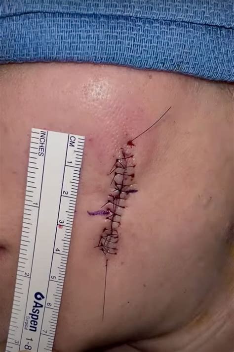 The Kardashians Shows Khlo Kardashian S Skin Cancer Removal