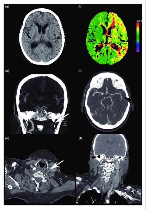 Computed Tomography Ct Scan Of The Head Time To Peak Perfusion Map Download Scientific
