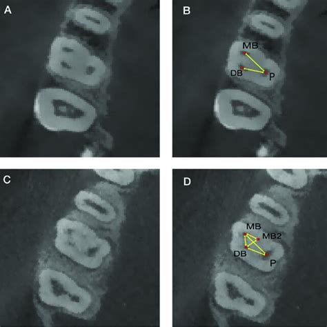 Maxillary Right First Molars With And Without Mb2 Canals A The