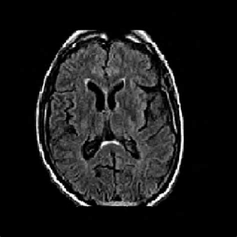 Figure 2 From Focal Lesion In Splenium Of Corpus Callosum On Flair Mri Common Findings In Aged