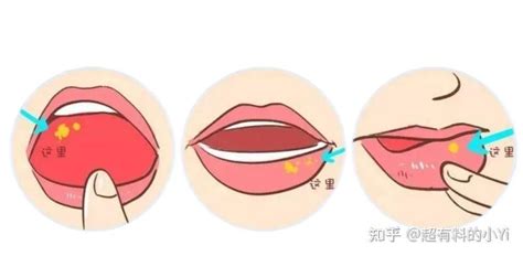 口腔溃疡 知乎