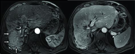 Diffusion Mr Showed Mild Diffusion Restriction In The Posterior Segment