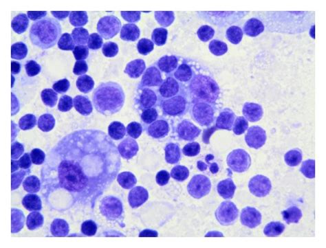 Distinct Histologic Features Of Macrophages Containing Other Cell