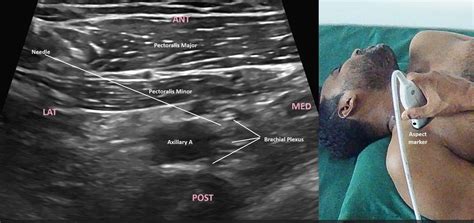 Usg Guided Brachial Plexus Block A Precision Approach
