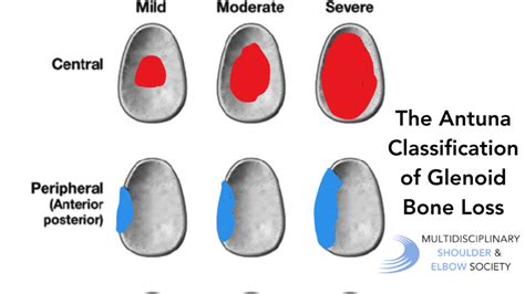 Classification Systems For Arthritic Glenoid Bone Loss