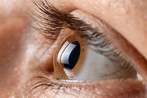 Does Lasik Surgery Cause Keratoconus Visual Aids Centre