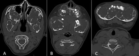 Clinico Radiological Features Of Cherubism Bmj Case Reports