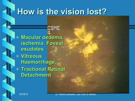 Diabetic Maculopathy1 Gos2 Ppt