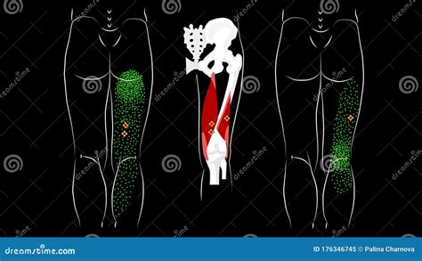 Trigger Points And Reflected Pain In The Hamstring Muscles Stock Image Trigger Points And Reflected Pain In The Hamstring Muscles Stock Image
