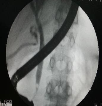 Intraoperative Cholangiogram Download Scientific Diagram