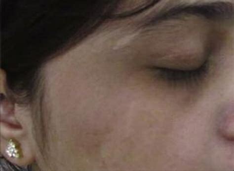 Periorbital Hyperpigmentation With Pigmentary Demarcation Line G Type