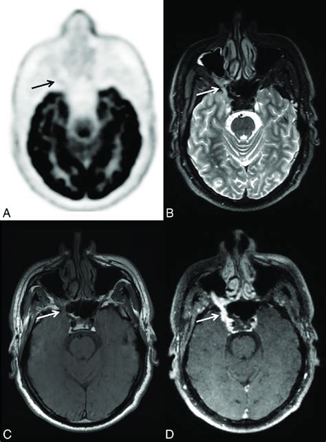 Initial Staging Of Right Adenoid Cystic Carcinoma Of A Minor Salivary Download Scientific