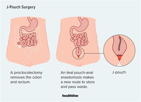 J Pouch Scars Everything You Need To Know About A J Pouch
