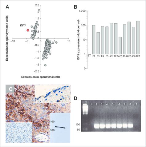 Expression Of Evi 1 In Infratentorial Ependymoma Microarray Analysis Download Scientific