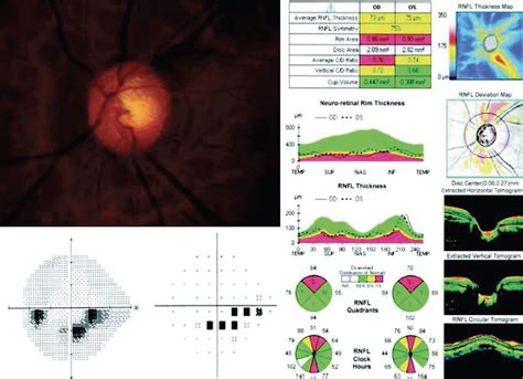 Glaucoma Today On Linkedin Normal Tension Glaucoma Pathogenesis Glaucoma Today