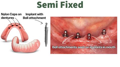 Denture Supported On Implants Full Mouth Teeth Semi Fixed