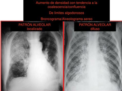 Ppt Radiologia Toracica Powerpoint Presentation Free Download Id