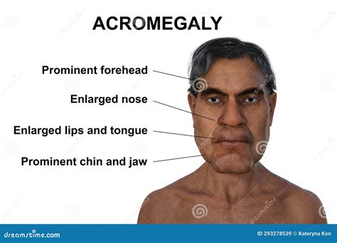 Acromegaly In A Man 3d Illustration 293278539
