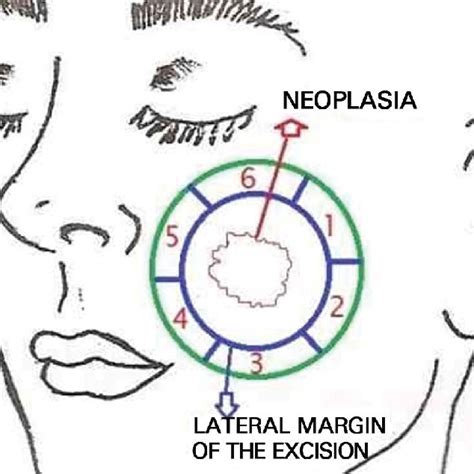 A Skin Lesion With A 0 5 Cm Lateral Margin Of Excision And 6 Marked Download Scientific Diagram