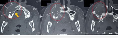 Computed Tomography Axial Section Shows Expansion Of The Buccal Cortex