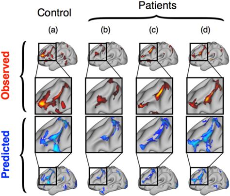 Resting Connectivity Predicts Task Activation In Pre Surgical Populations Abstract Europe Pmc