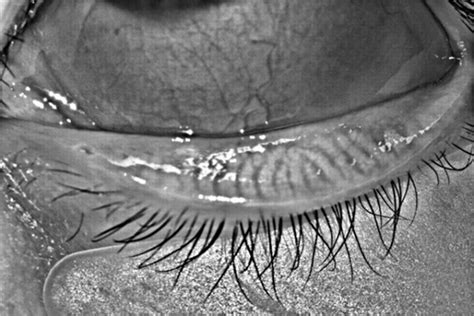 Dry Eye Evaluation In Richmond Hill On Richmond Hill Eye Clinic