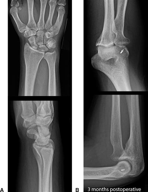 Figure 1 From Simultaneous Dislocation Of The Radiocapitellar And Distal Radioulnar Joints