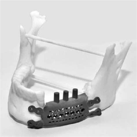 Cobalt Chromium Alloys Patient Specific Implants At Best Price In Thane