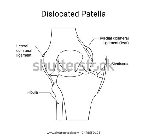 Diagram Dislocated Patella Medical Design Line Stock Vector Royalty