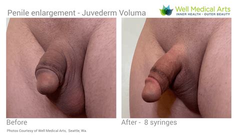 Male Enhancement Surgery Results
