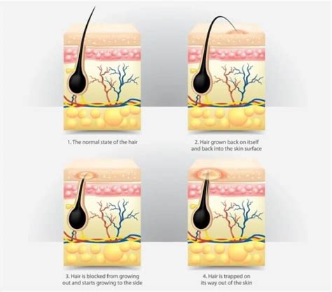 How To Prevent Ingrown Hairs From Shaving Sharpologist