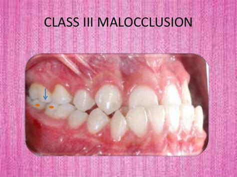 Angles Classification Of Malocclusion