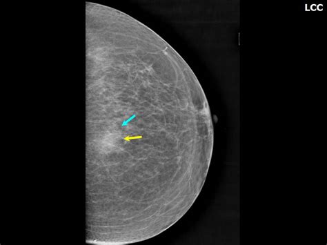 Atlas Of Breast Cancer Early Detection