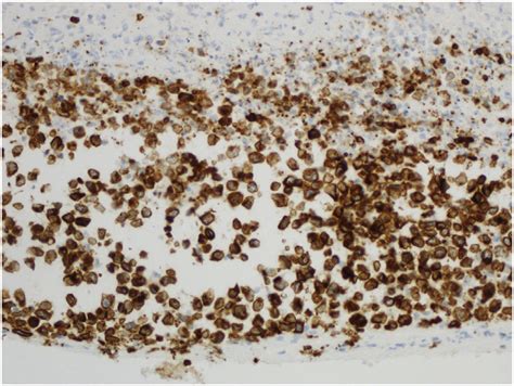 Cd79a Immunostain Showing Strong And Diffuse Staining In The Tumor
