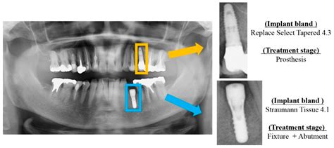 Dental Implant Xray